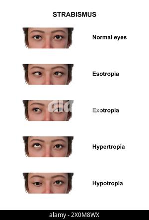 Illustration of a woman with various strabismus types: esotropia ...