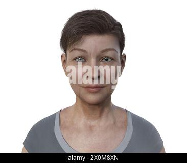 Illustration depicting a woman with anisocoria, highlighting uneven ...