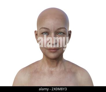 Illustration depicting a woman with miosis (constricted eye pupils ...