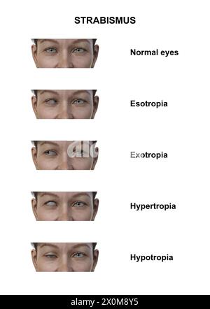 Illustration of a woman with various strabismus types: esotropia ...