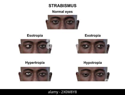 Illustration of a man with various strabismus types: esotropia ...