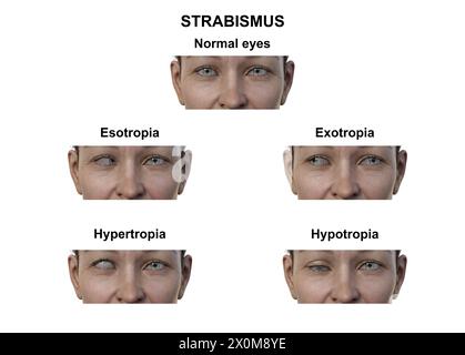 Illustration of a woman with various strabismus types: esotropia ...