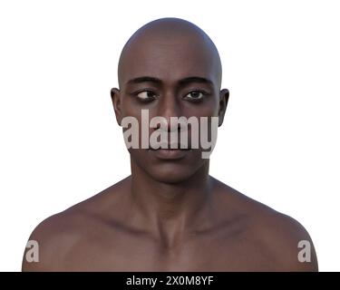 Illustration of a man with esotropia showing inward eye misalignment ...