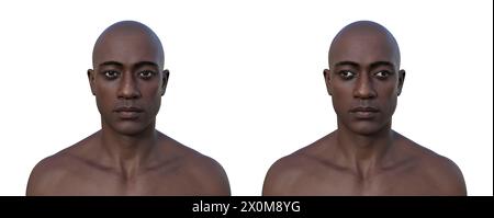 Illustration of a man with exotropia demonstrating outward eye ...