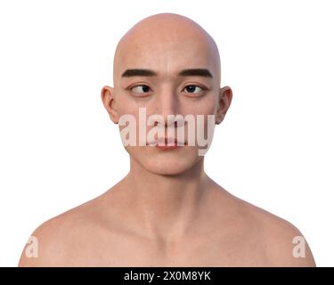 Illustration of a man with esotropia showing inward eye misalignment ...