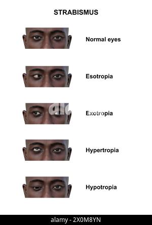 Illustration of a man with various strabismus types: esotropia ...