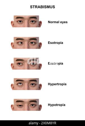 Illustration of a man with various strabismus types: esotropia ...