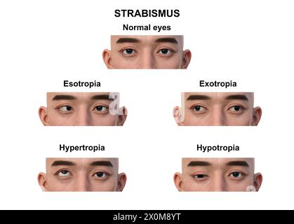 Illustration of a man with various strabismus types: esotropia ...