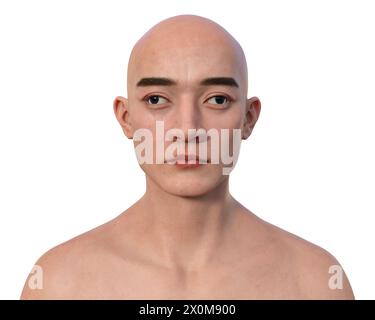 Illustration of a man with exotropia demonstrating outward eye ...