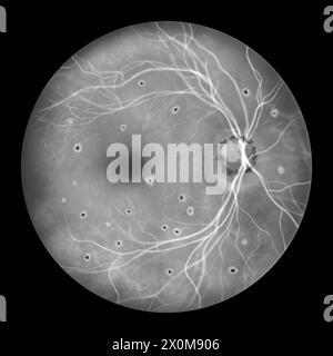 Illustration of a retina affected by presumed ocular histoplasmosis ...