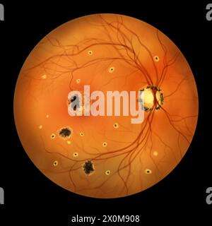Illustration of a retina affected by presumed ocular histoplasmosis ...