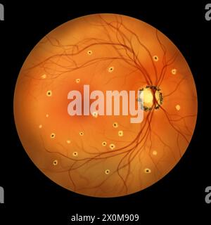 Illustration of a retina affected by presumed ocular histoplasmosis ...