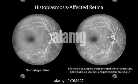 Illustration of a retina affected by presumed ocular histoplasmosis ...