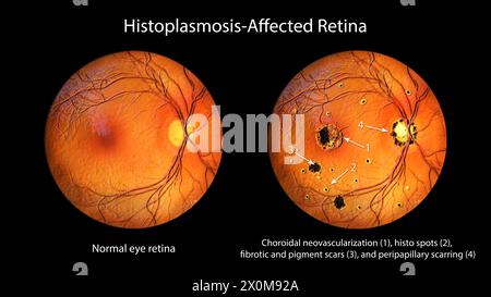 Illustration of a retina affected by presumed ocular histoplasmosis ...