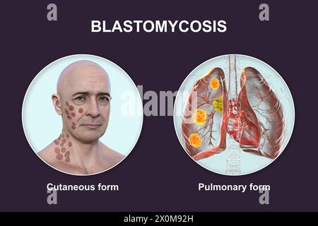3D illustration showing two clinical presentations of blastomycosis ...