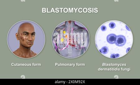 3D illustration showing two clinical presentations of blastomycosis and ...