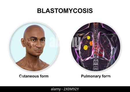 3D illustration showing two clinical presentations of blastomycosis ...