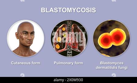 3D illustration showing two clinical presentations of blastomycosis and ...