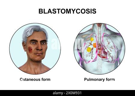 3D illustration showing two clinical presentations of blastomycosis and ...