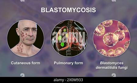 3D illustration showing two clinical presentations of blastomycosis and ...