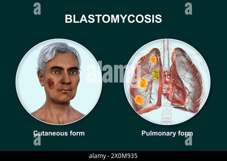 3D illustration showing two clinical presentations of blastomycosis ...