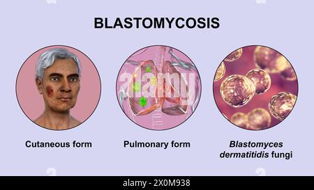 3D illustration showing two clinical presentations of blastomycosis and ...