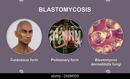 3D illustration showing two clinical presentations of blastomycosis and ...