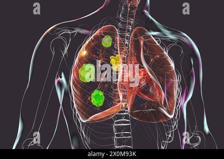 3D illustration of pulmonary blastomycosis, a fungal lung infection ...
