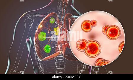 3D illustration of pulmonary blastomycosis, and a close-up of the ...