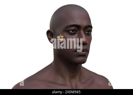 3D illustration of a man with an infection of the middle ear, known as ...