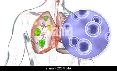 3D illustration of pulmonary blastomycosis, and a close-up of the ...