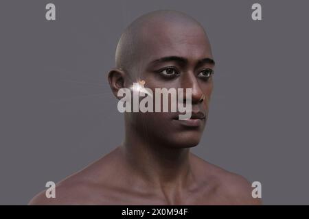 3D illustration of a man with an infection of the middle ear, known as ...