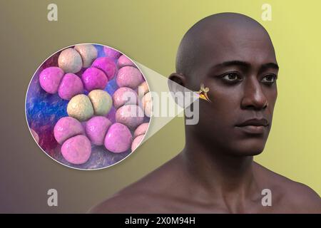 3D illustration of a man with an infection of the middle ear, known as ...