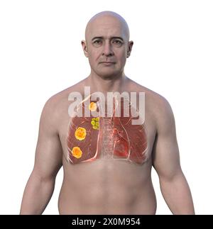 3D illustration of pulmonary blastomycosis, a fungal lung infection ...