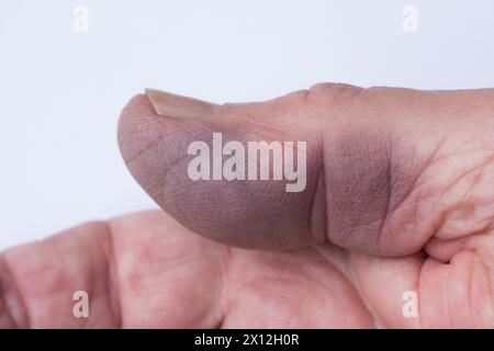 black bruised thumb due to Achenbach syndrome, subcutaneous bruise, man ...