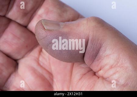 black bruised thumb due to Achenbach syndrome, subcutaneous bruise, man ...