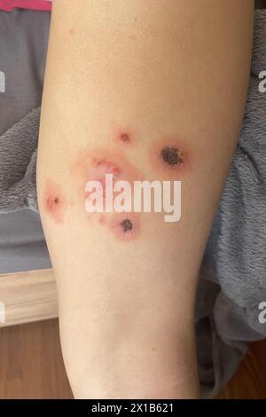 Intertrigo. Close-up of an intertrigo rash on the groin of an elderly ...