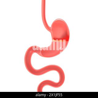 Acid reflux or Heartburn, stomach is on the woman's body gray ...
