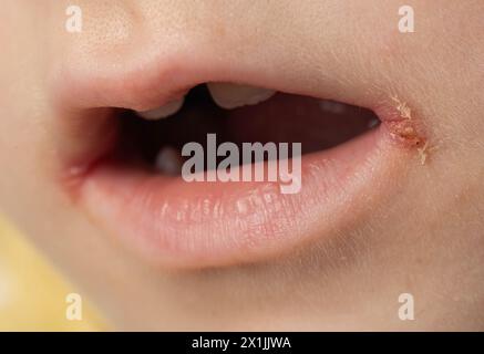 Pain and itching in the corners of the lips of a girl's mouth. Seizures ...
