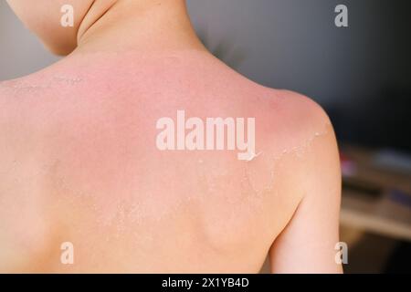 back of a child with sunburns and peeling dead skin of a 6-7 year old ...