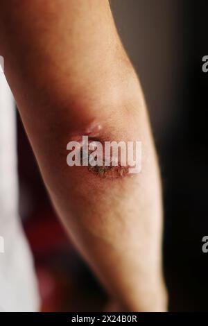 skin burn in the healing stage on the log Stock Photo - Alamy