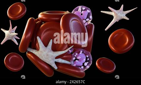 A 3D rendering of blood clot that travels to another part of the body ...