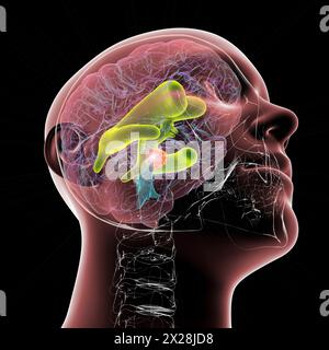 Brain tumour causing hydrocephalus, illustration Stock Photo - Alamy