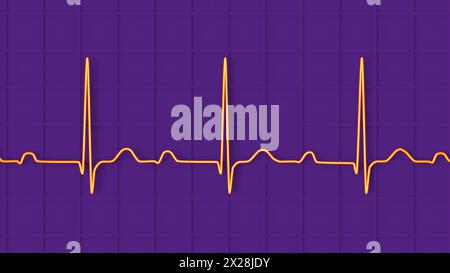 ECG displaying first degree AV block, illustration Stock Photo - Alamy