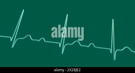 ECG displaying first degree AV block, illustration Stock Photo - Alamy