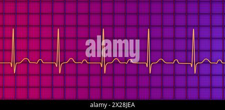 ECG displaying first degree AV block, illustration Stock Photo - Alamy