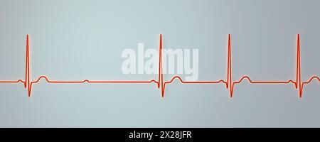 ECG with second degree Mobitz 2 AV block, illustration Stock Photo - Alamy