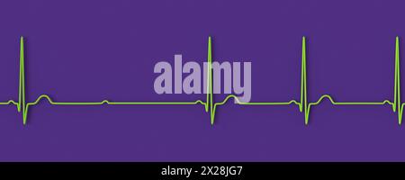 ECG with second degree Mobitz 2 AV block, illustration Stock Photo - Alamy