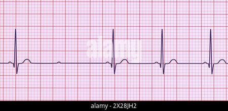 ECG with second degree Mobitz 2 AV block, illustration Stock Photo - Alamy