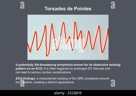 ECG displaying Torsades de pointes rhythm, illustration Stock Photo - Alamy